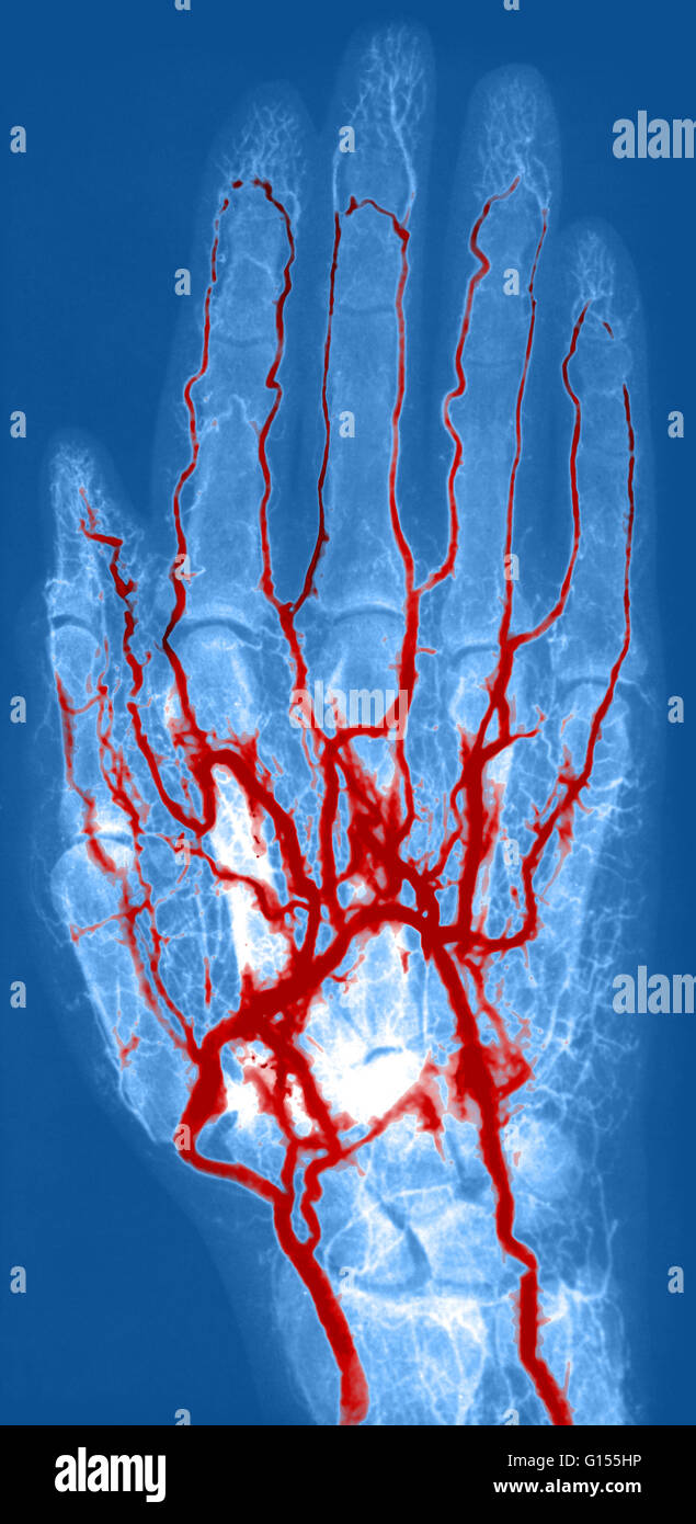 Right Ulnar Artery