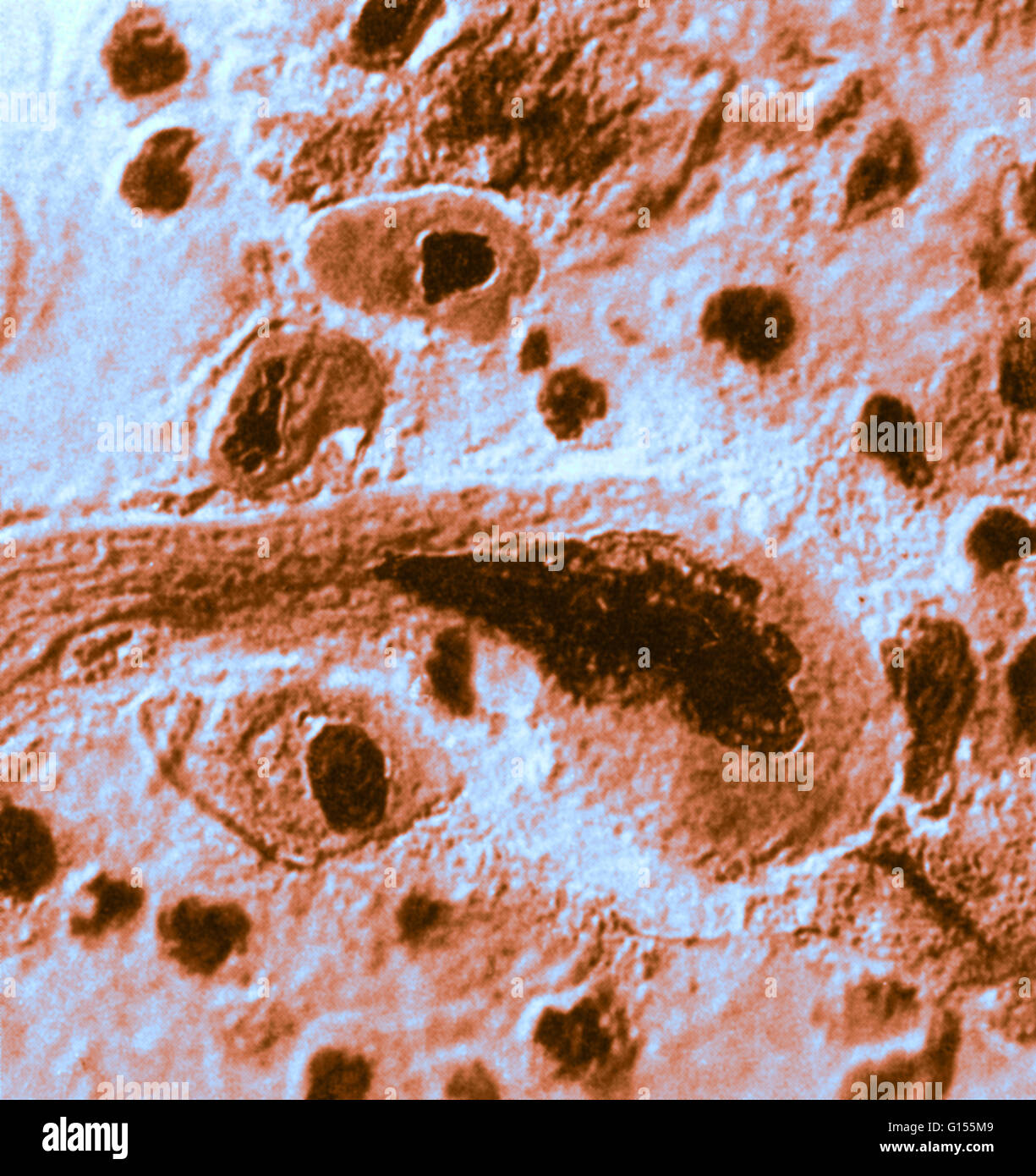 Color enhanced micrograph showing cells from advanced lung cancer. The ...