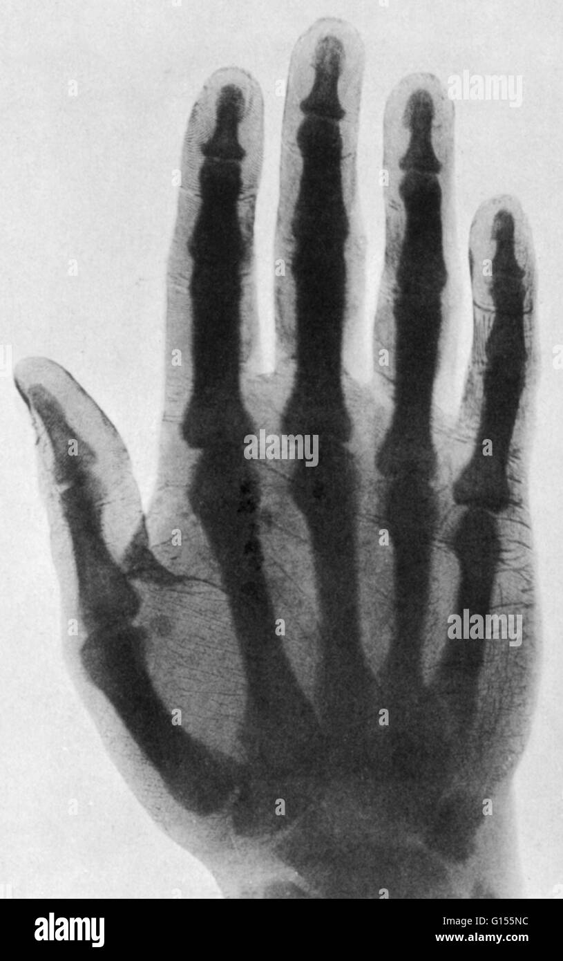 Enhanced early x-ray. One of the clearest of the early class of ...