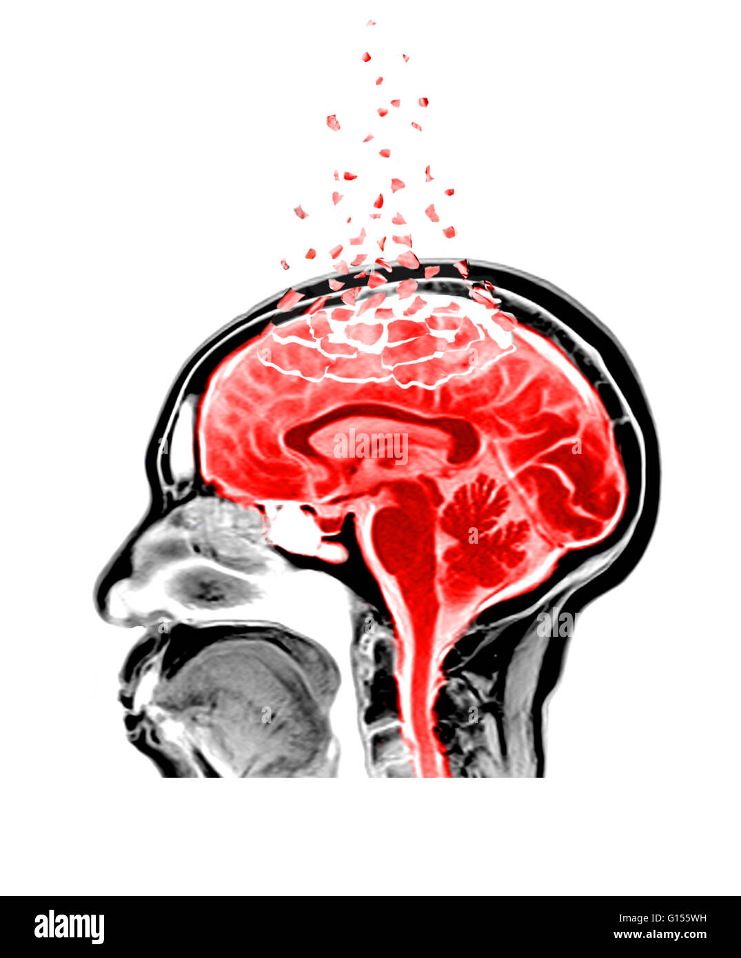 Alzheimers Memory Loss