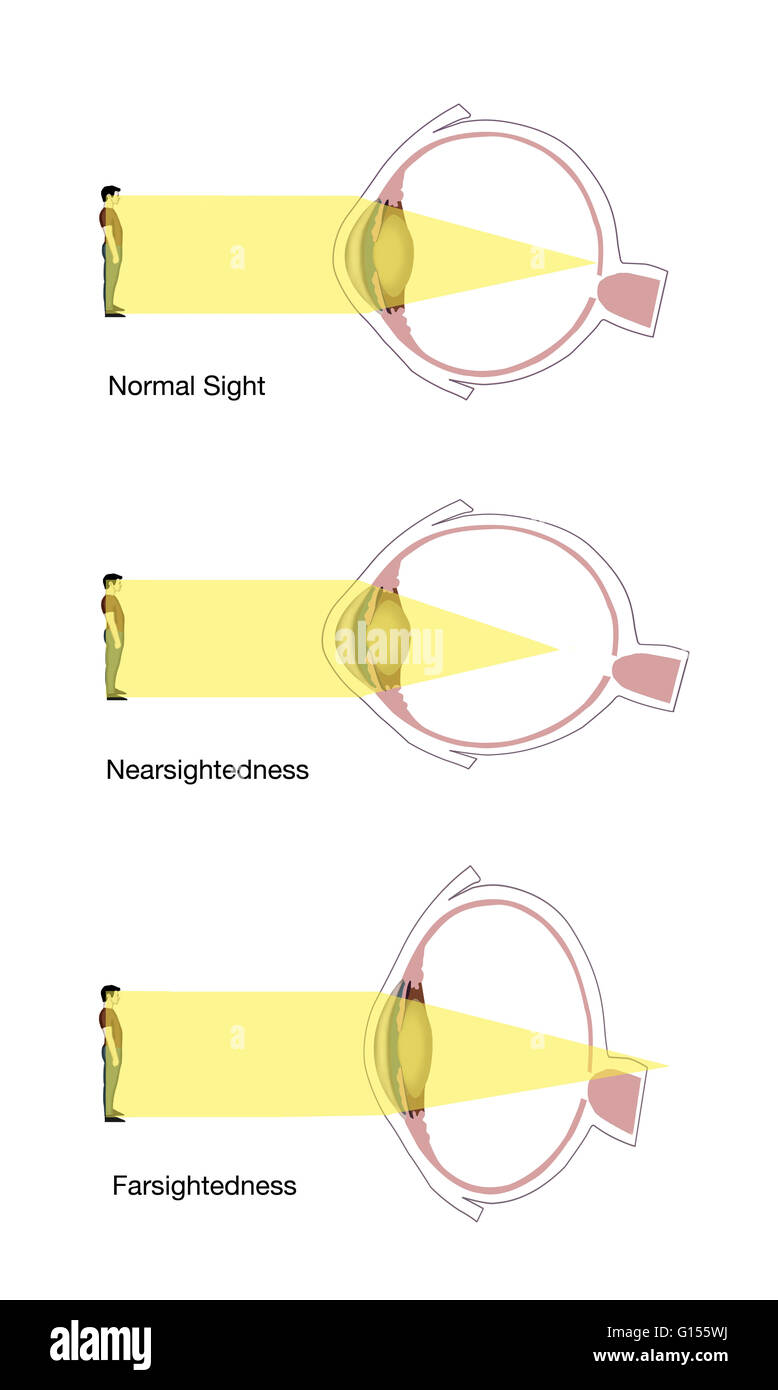 Diagram showing a healthy eye, the eye of a patient with myopia ...