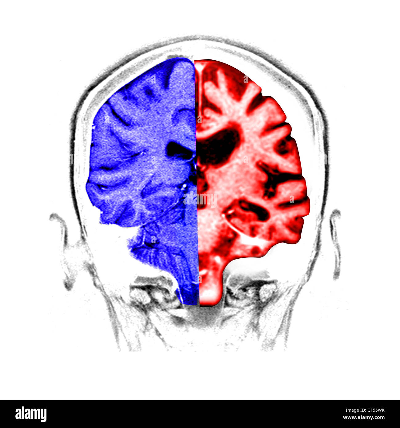 Brain Scan Frontal Lobe Dementia