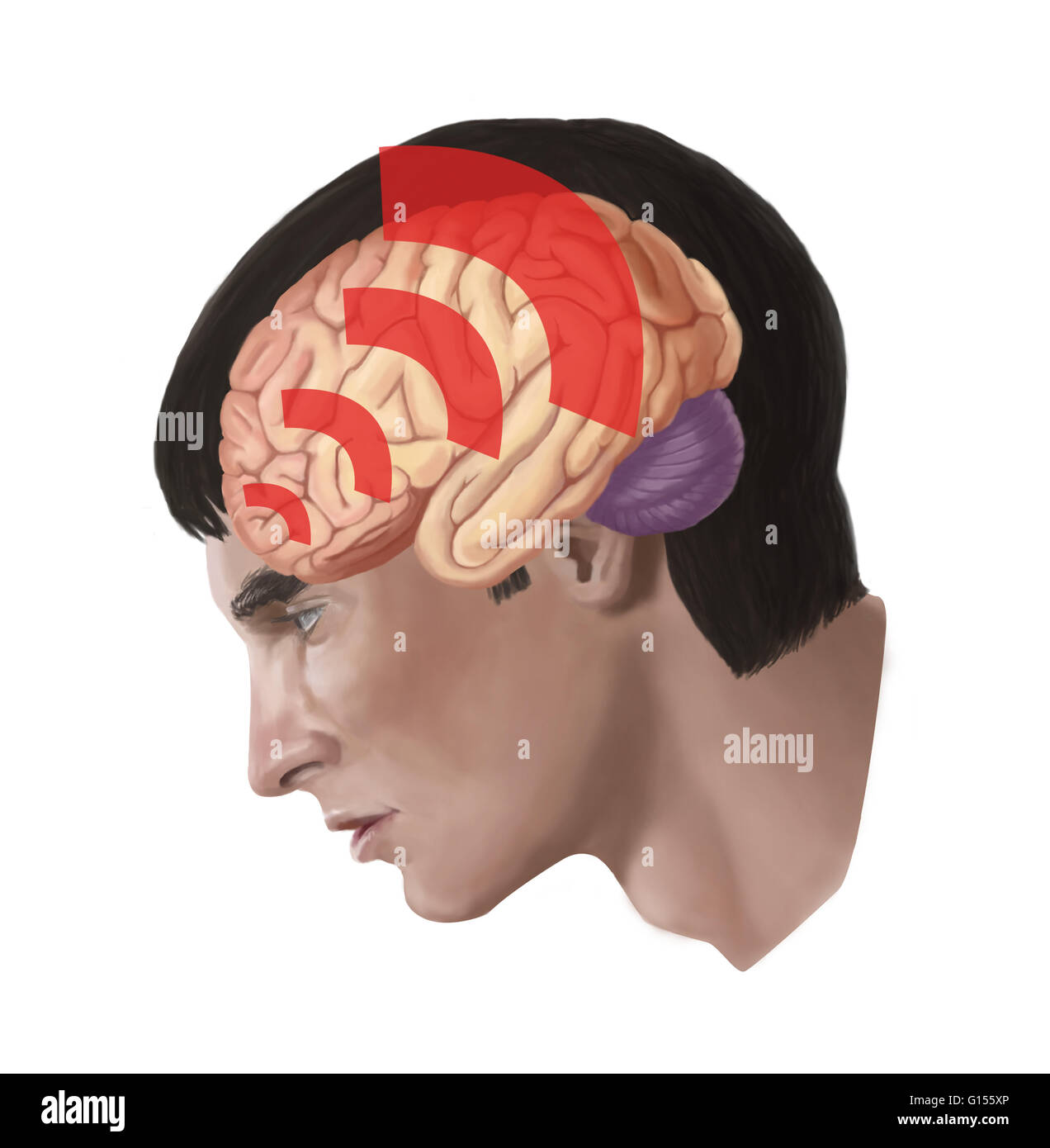 Illustration demonstrating a football player getting a concussion Stock ...