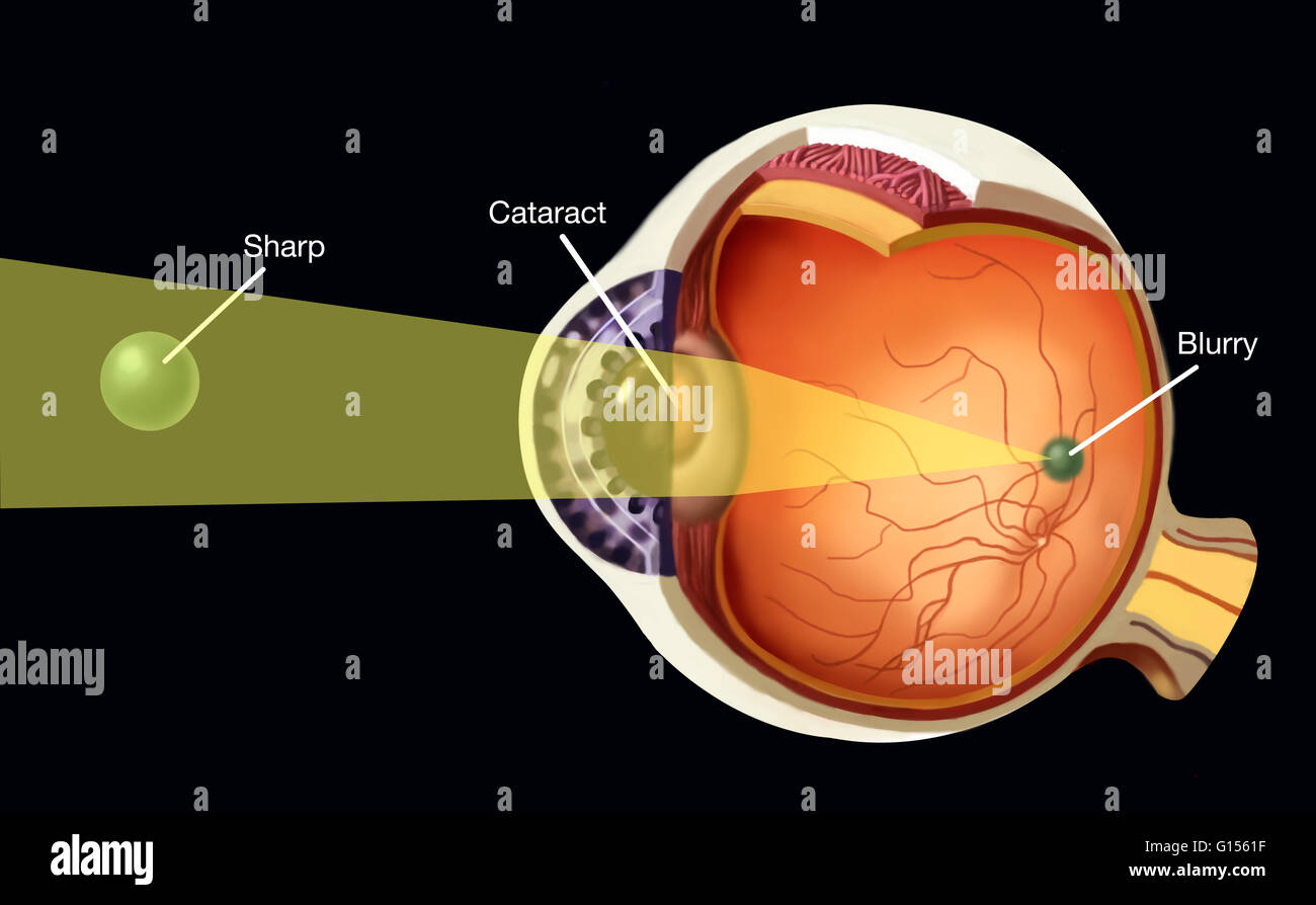 Cataract drawing hi-res stock photography and images - Alamy