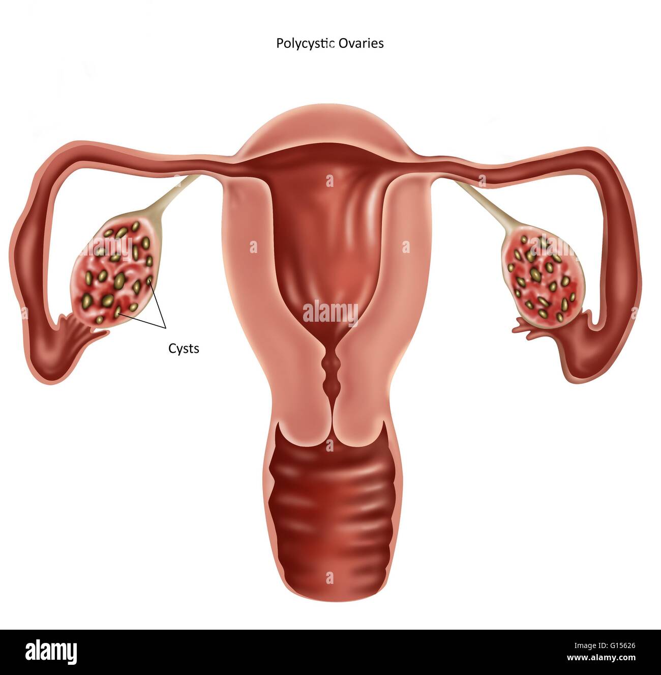 Illustration of polycystic ovaries. Ovarian cysts are collections of fluid surrounded by very ...