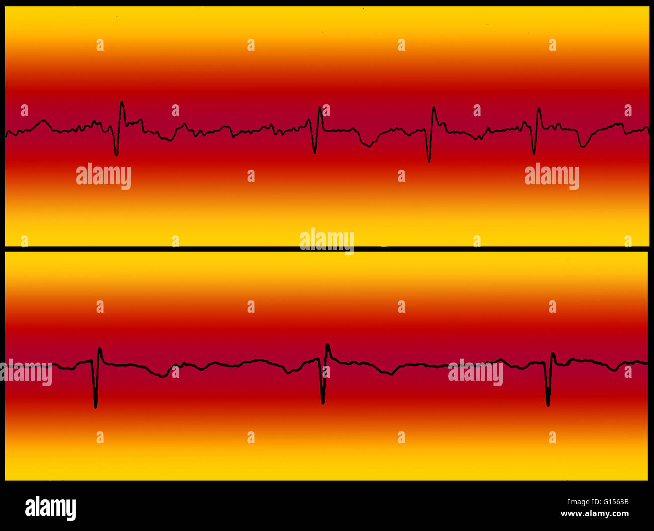 Composite image comparing an electrocardiogram (ECG) readout of atrial ...