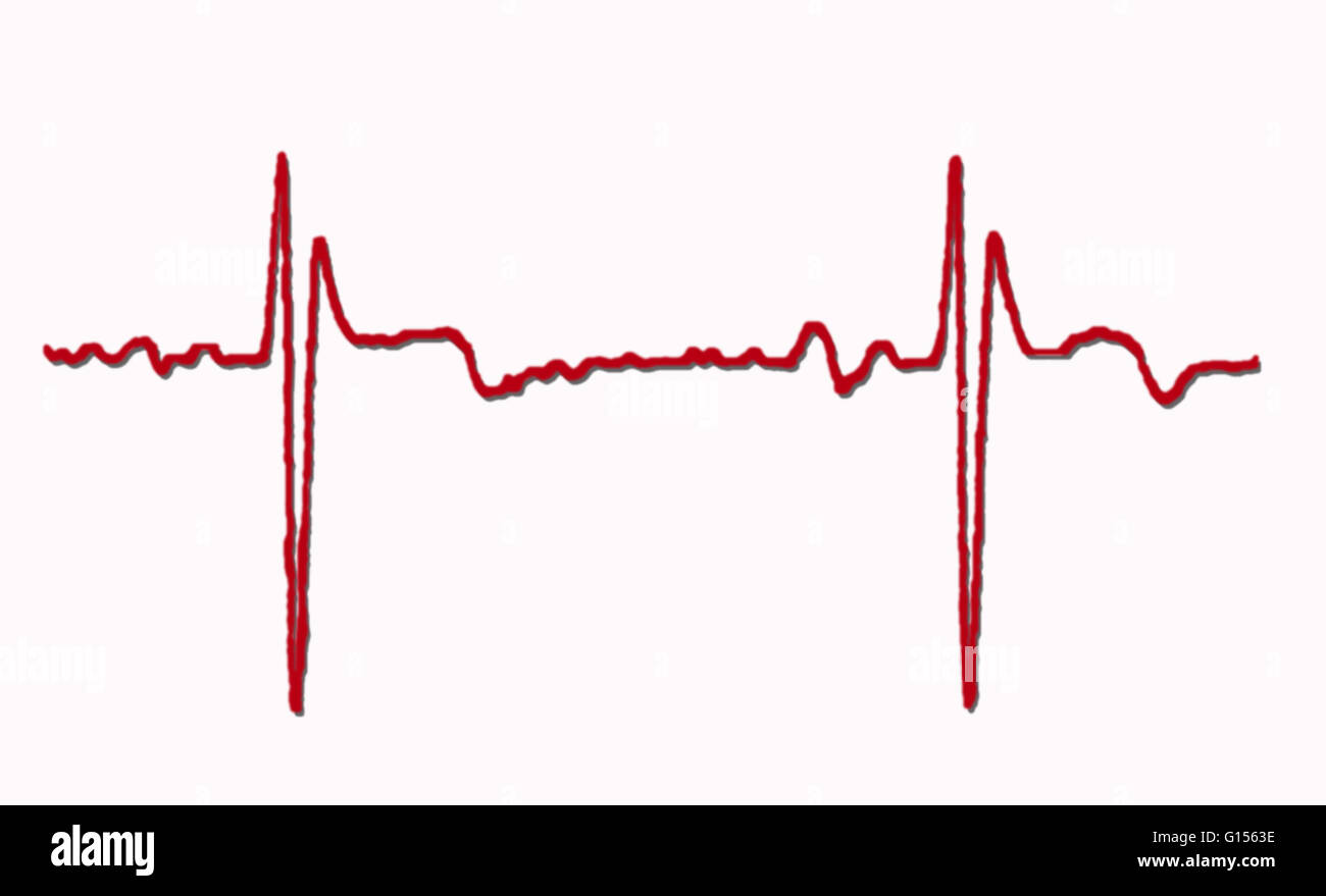 Segment Normal Heart Beat