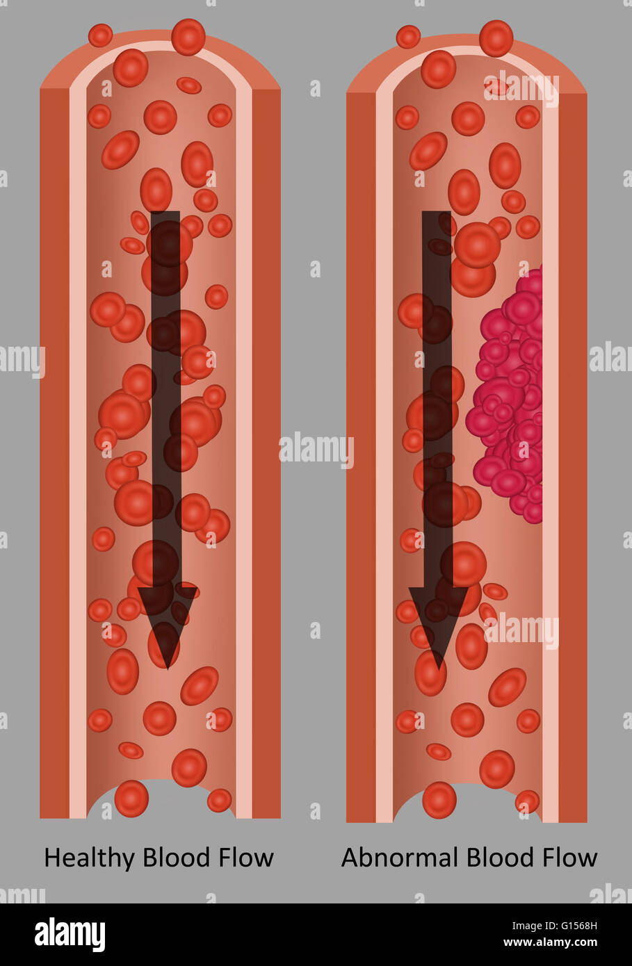 Illustrations showing healthy blood flow and abnormal blood flow (blood ...