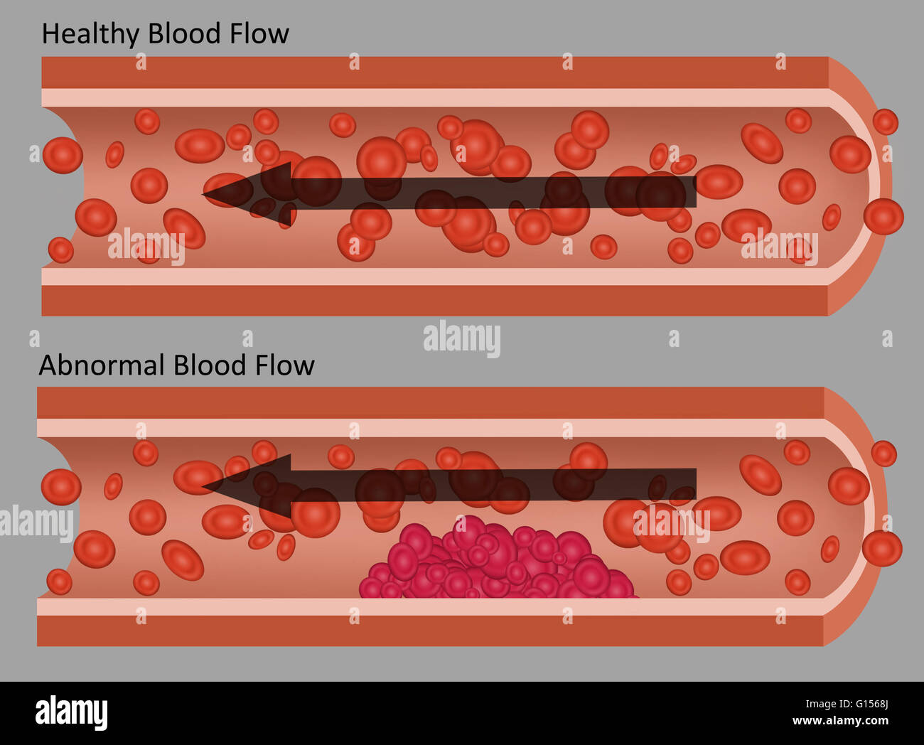 Arterial thrombosis drawing hi-res stock photography and images - Alamy