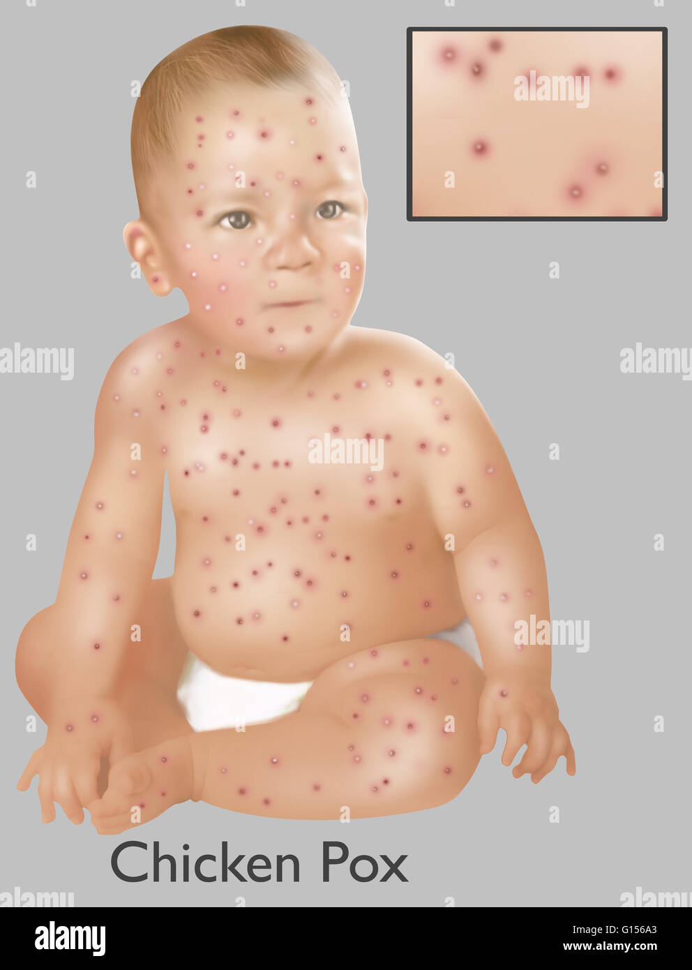 Baby rash and illustration hi-res stock photography and images - Alamy