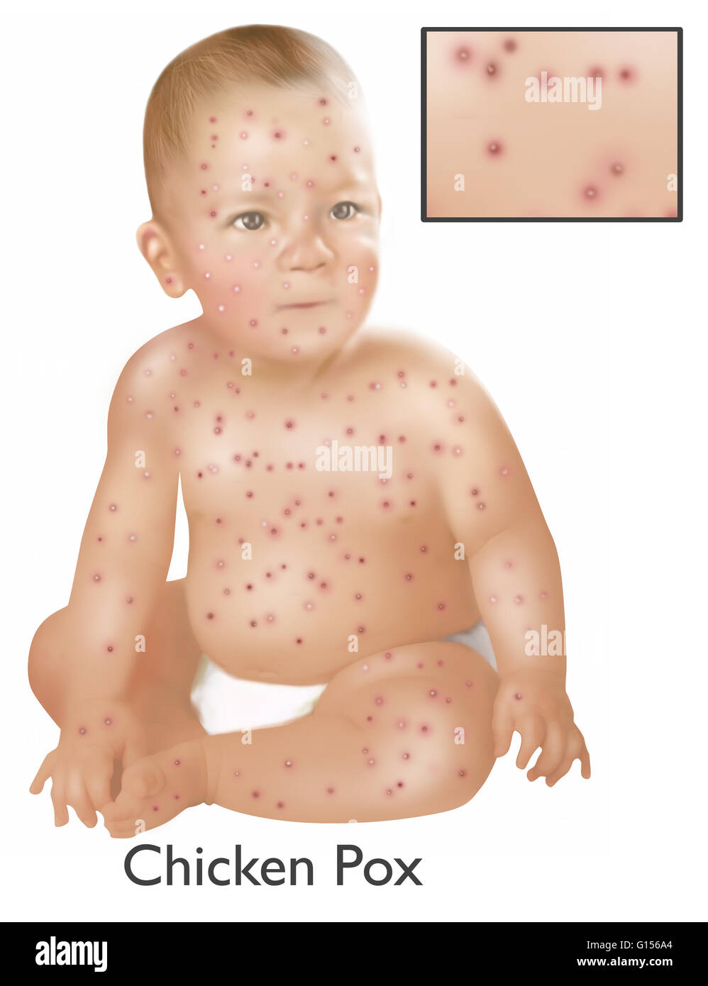 Baby rash and illustration hi-res stock photography and images - Alamy