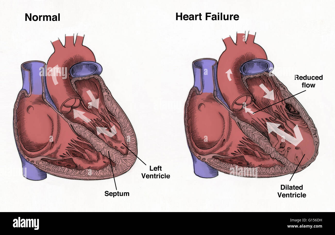 Illustration comparing the appearance and functioning of the heart of a ...