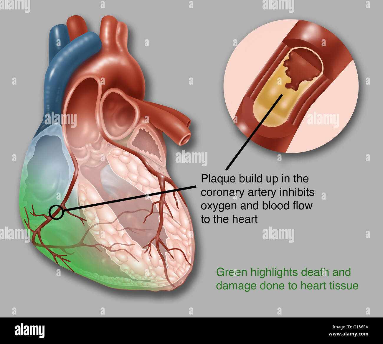 Impeded blood flow hi-res stock photography and images - Alamy
