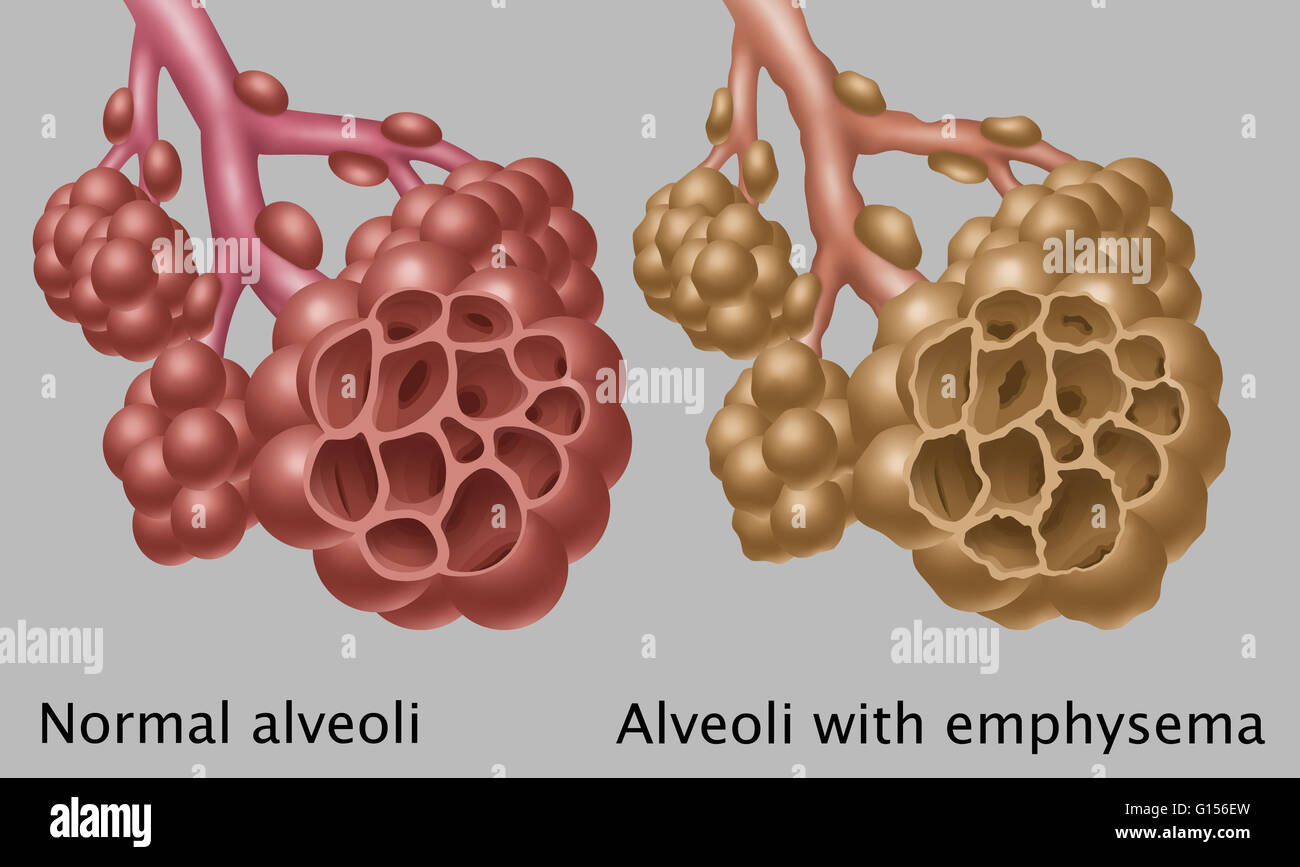 Illustration comparing the appearance of normal alveoli (left) with ...