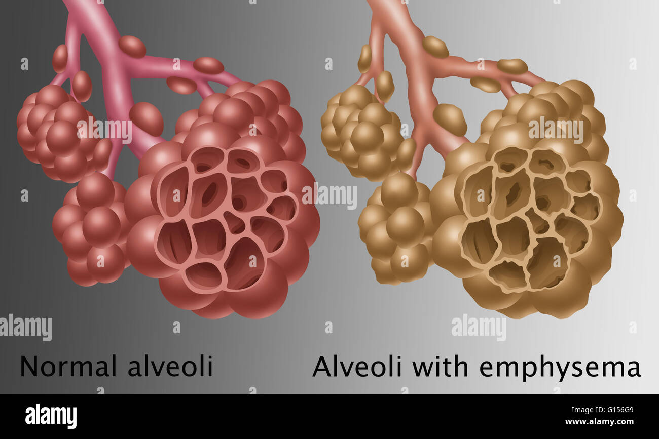 Illustration comparing the appearance of normal alveoli (left) with ...