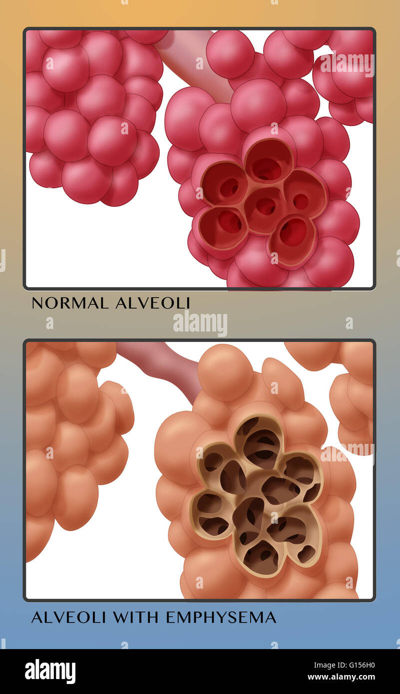 Illustration comparing the appearance of healthy alveoli (top) and ...