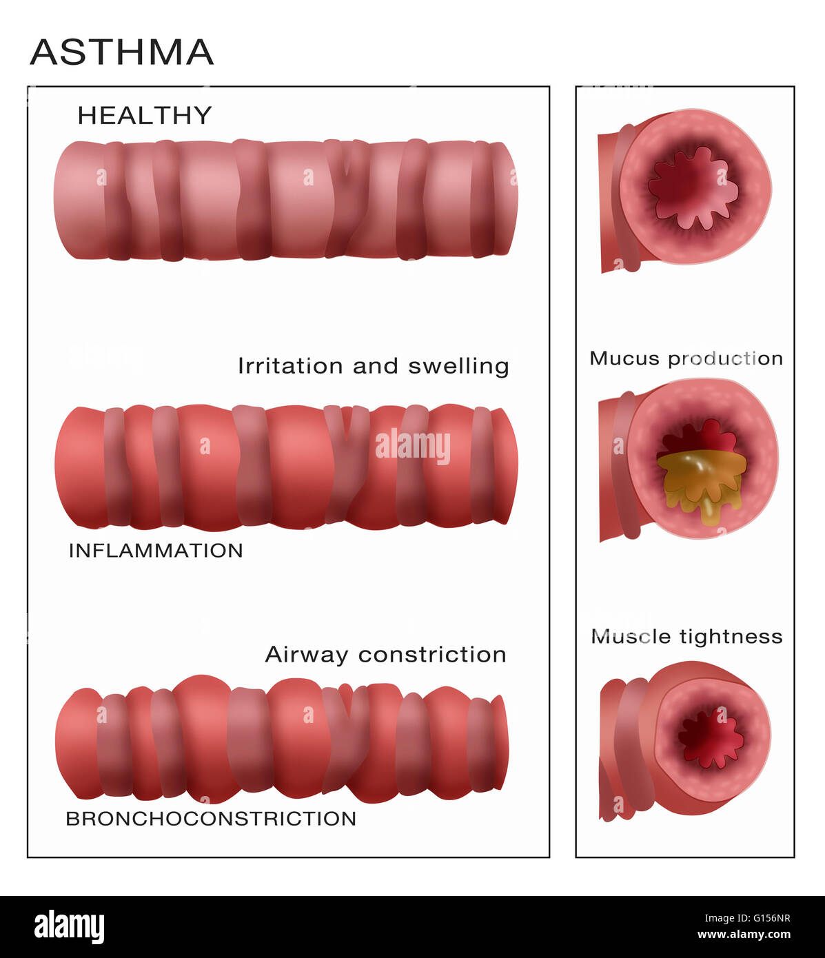 Respiratory mucus artwork hi-res stock photography and images - Alamy
