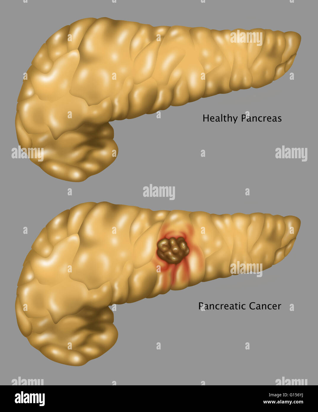 Illustration of a healthy pancreas (top) compared to a cancerous ...