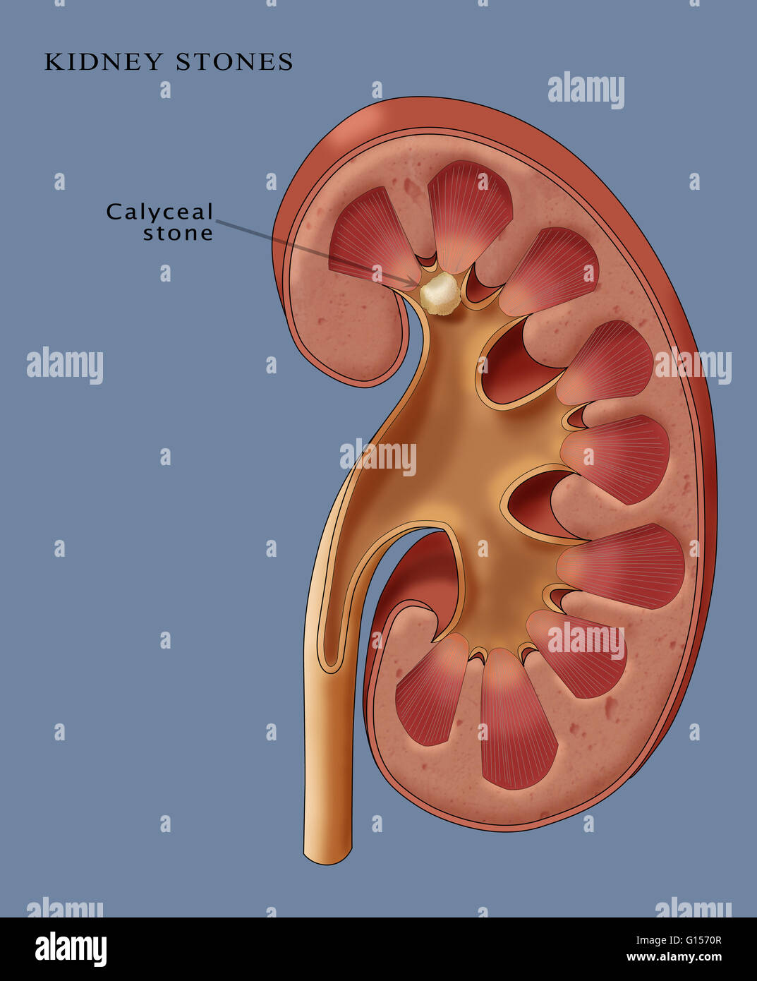 Illustration of a kidney stone present in one of the calyxes; a ...