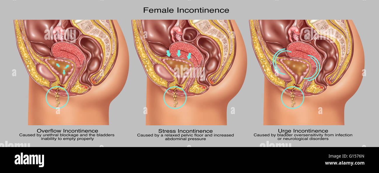 Illustration Depicting Three Types Of Incontinence Left To Right