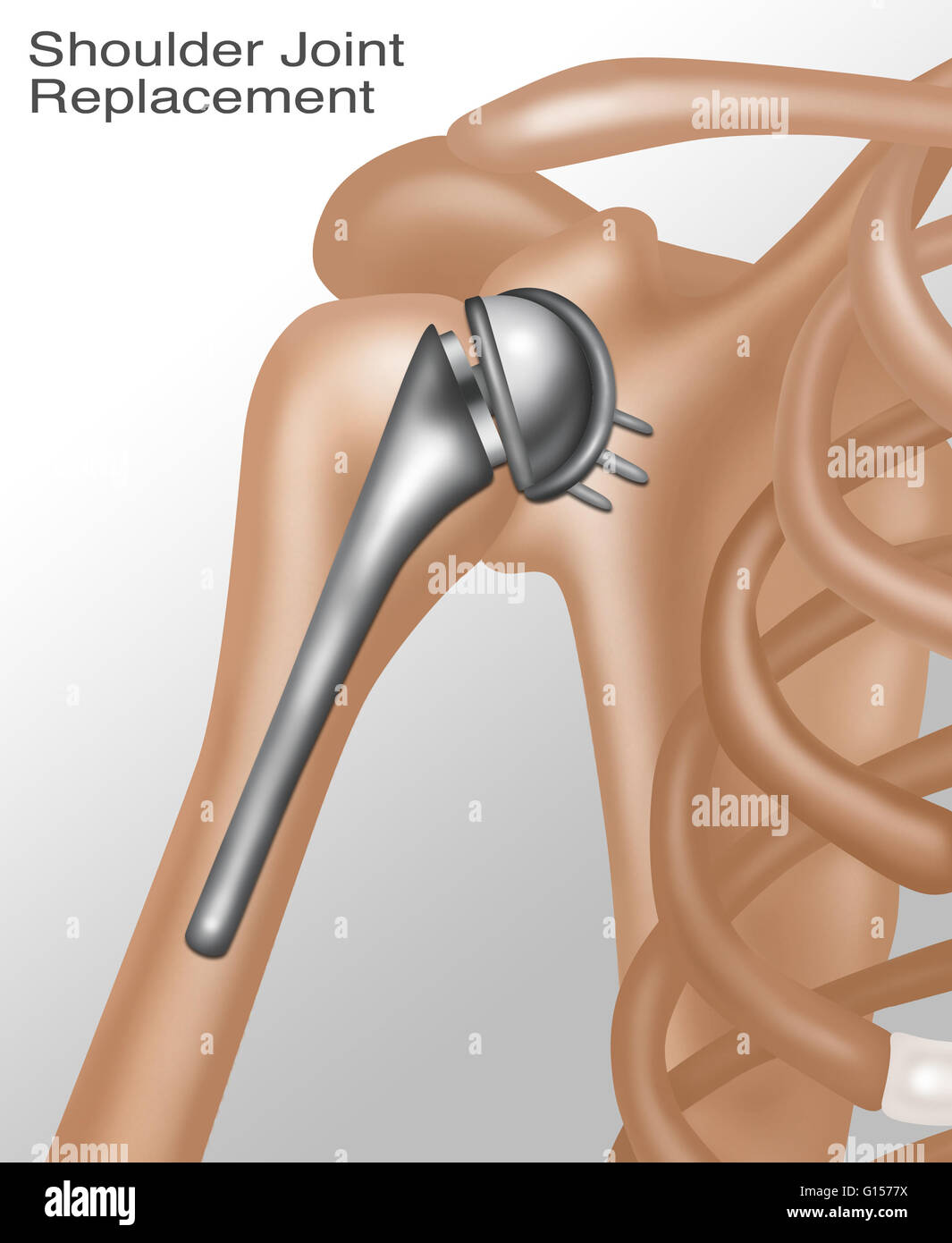 Illustration of a shoulder joint replacement Stock Photo - Alamy