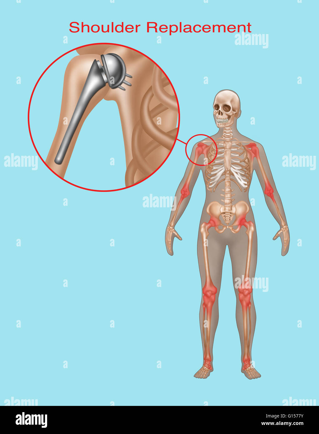 Illustration of a shoulder joint replacement Stock Photo - Alamy