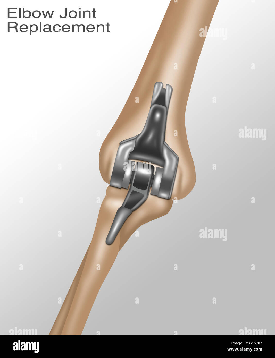 Elbow Joint Replacement High Resolution Stock Photography and Images ...