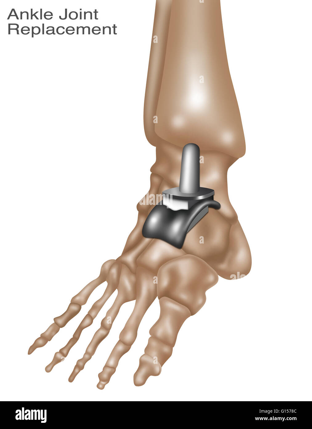 Illustration of an ankle joint replacement Stock Photo - Alamy