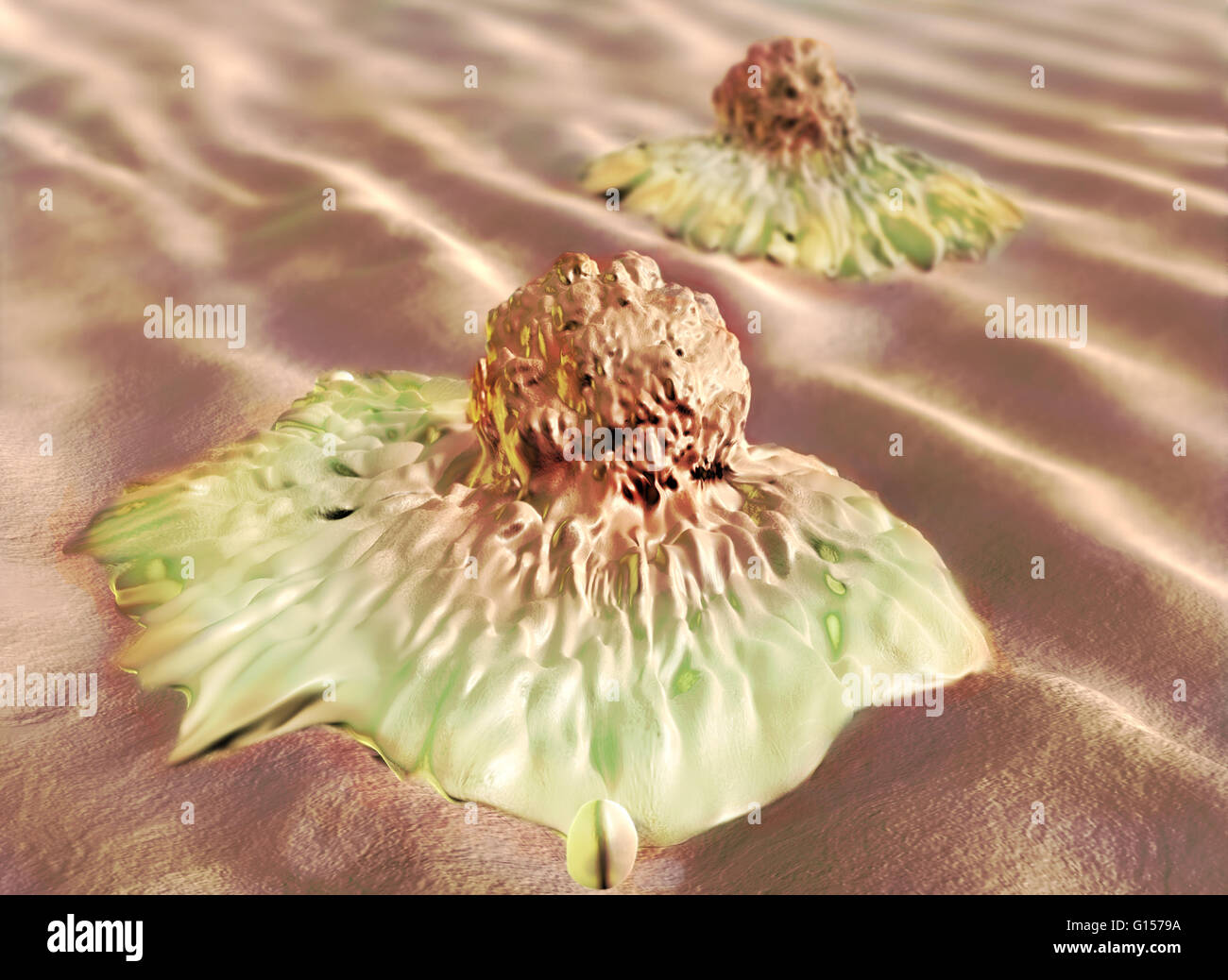 Illustration of a cancer cells in the human colon (large intestine ...