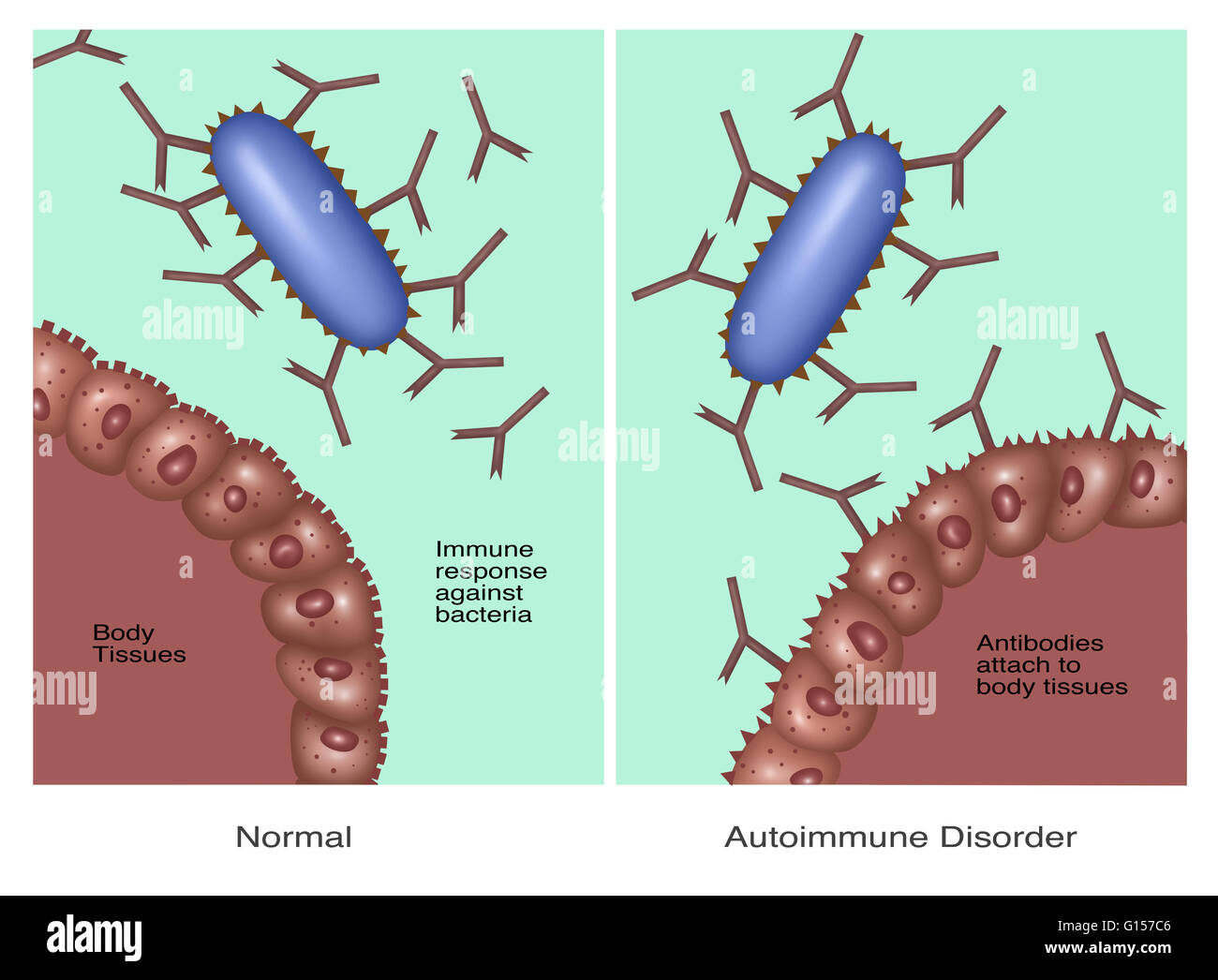 Illustration comparing a normal immune system (left) to the affects of ...
