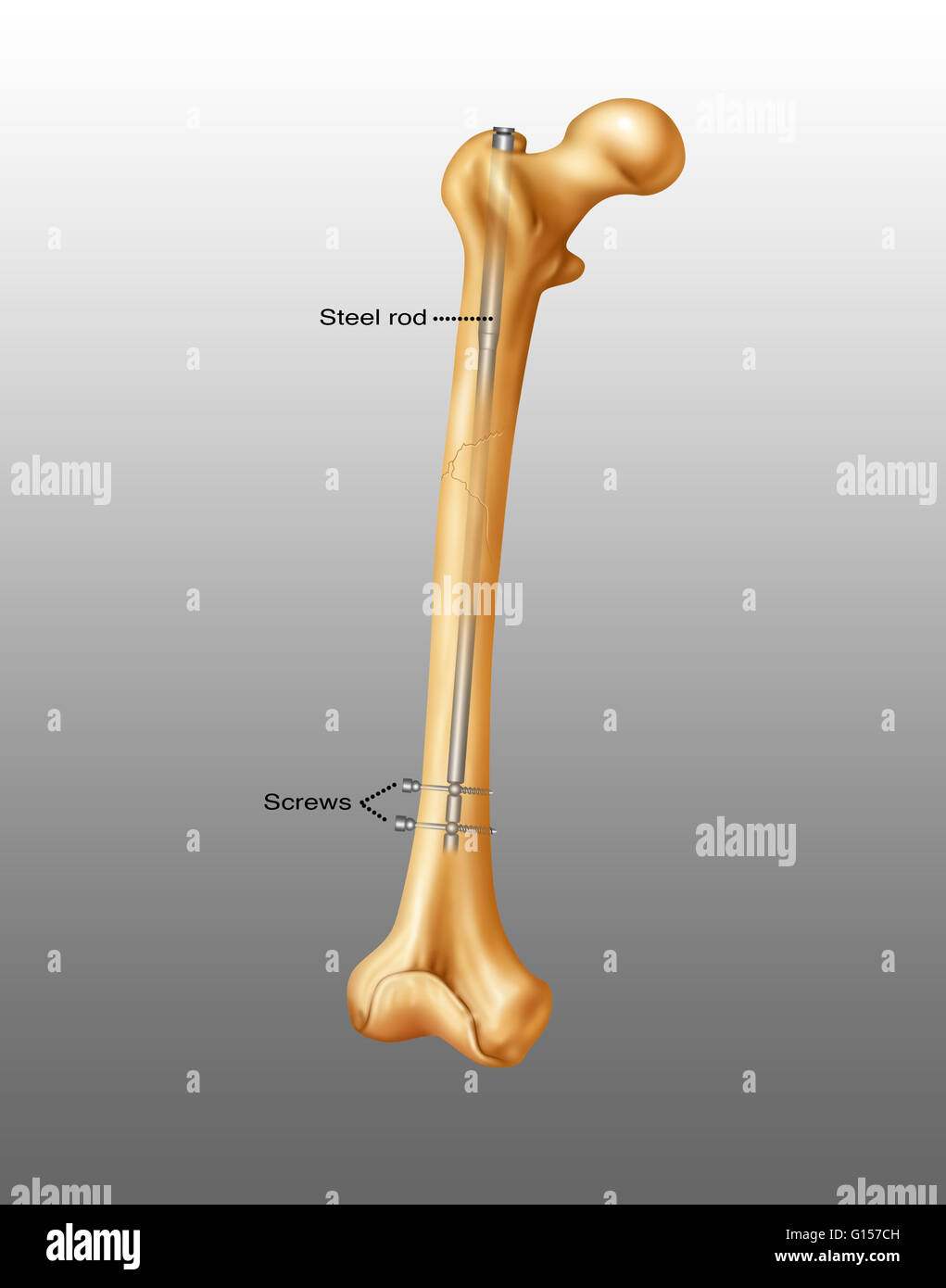 Femur fracture repair Stock Photo - Alamy