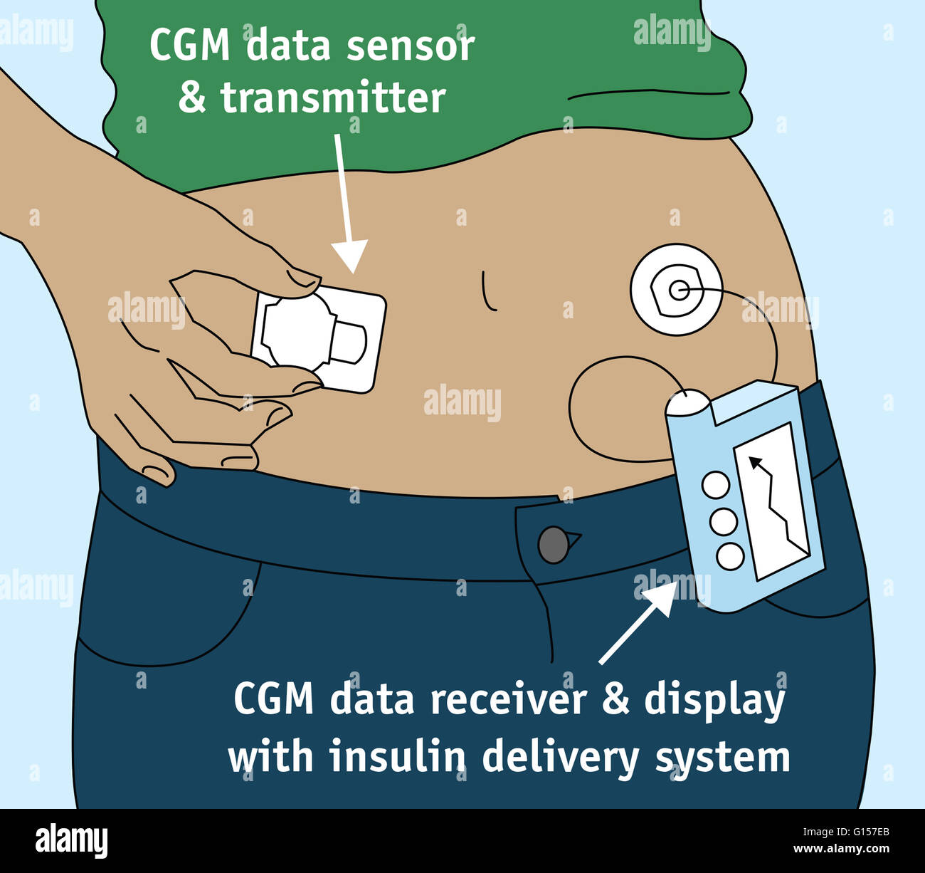 Continuous glucose monitoring device High Resolution Stock Photography ...