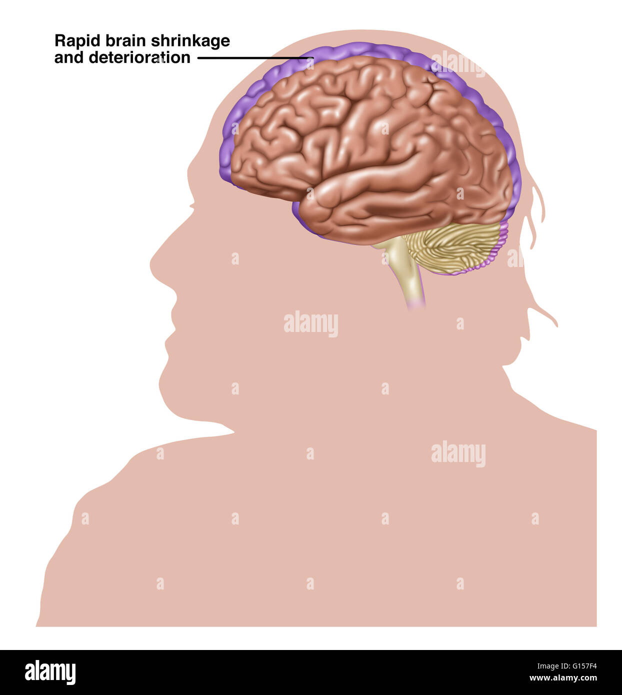 Rapid deterioration hi-res stock photography and images - Alamy