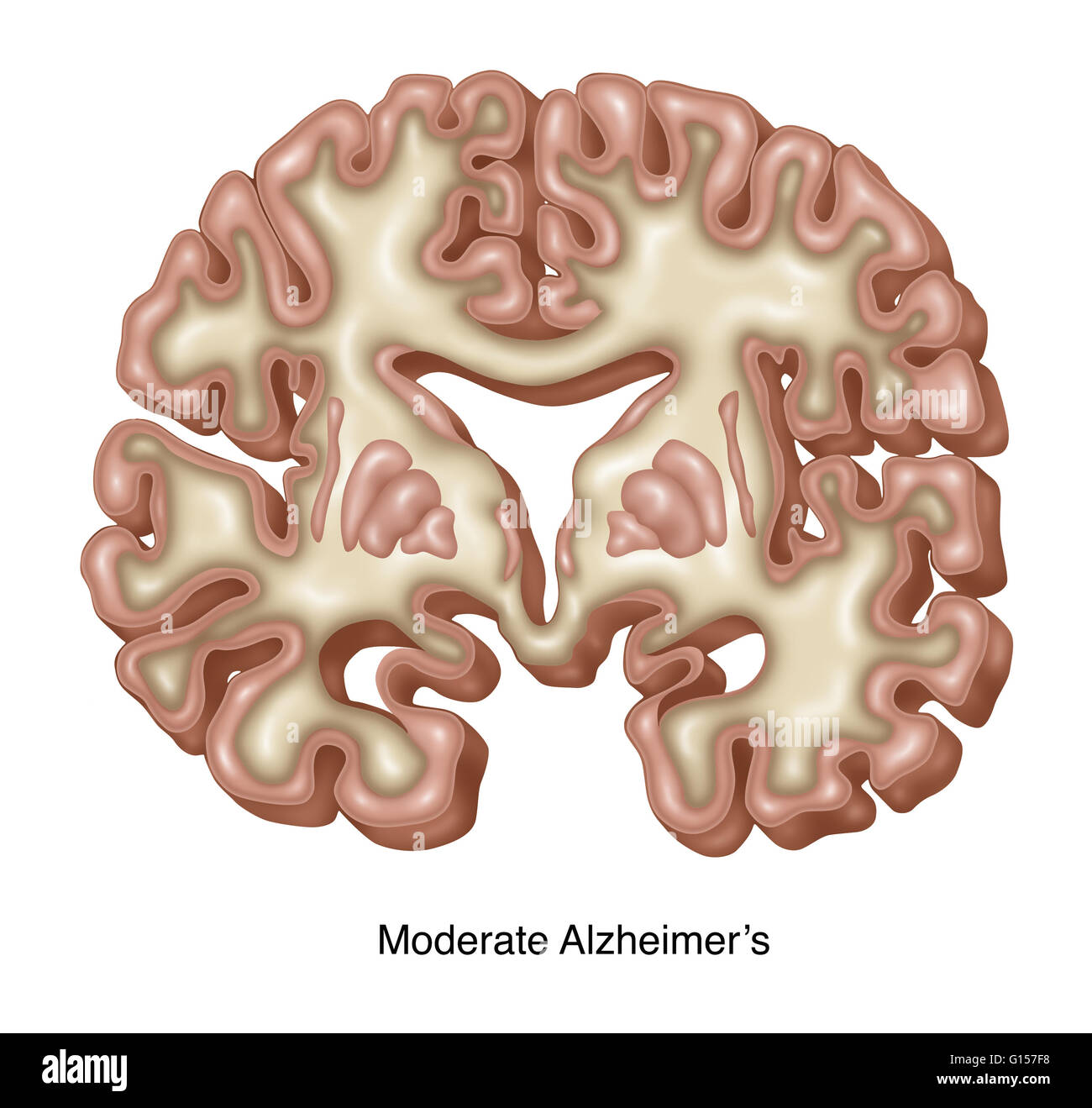 Shrinkage Of Cerebellum
