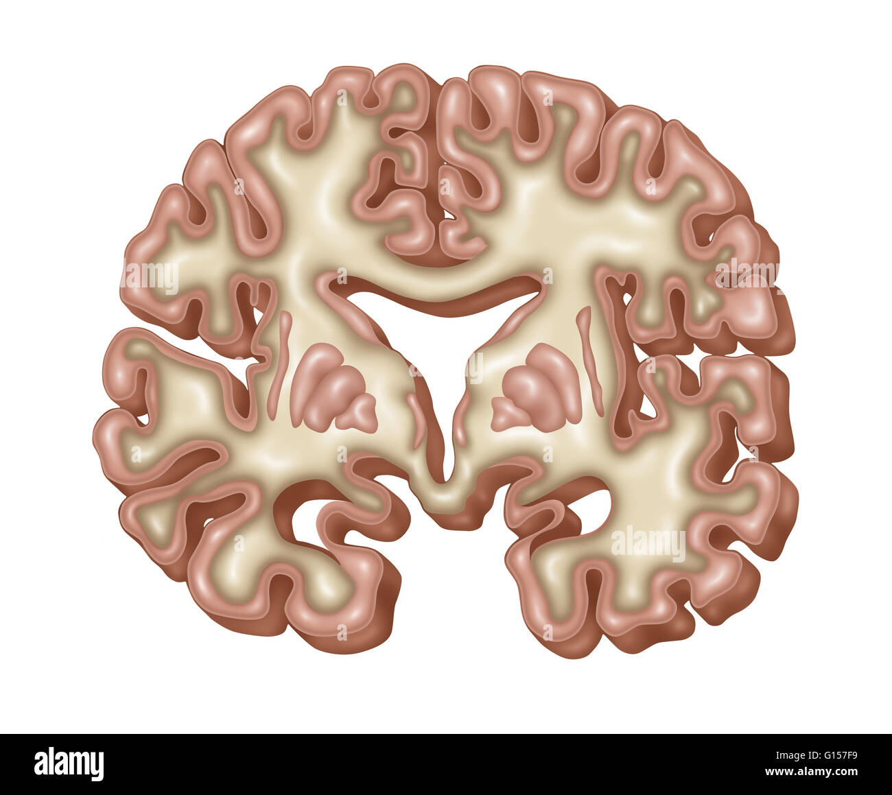 Illustration showing a cross section of brain with moderate alzheimers ...