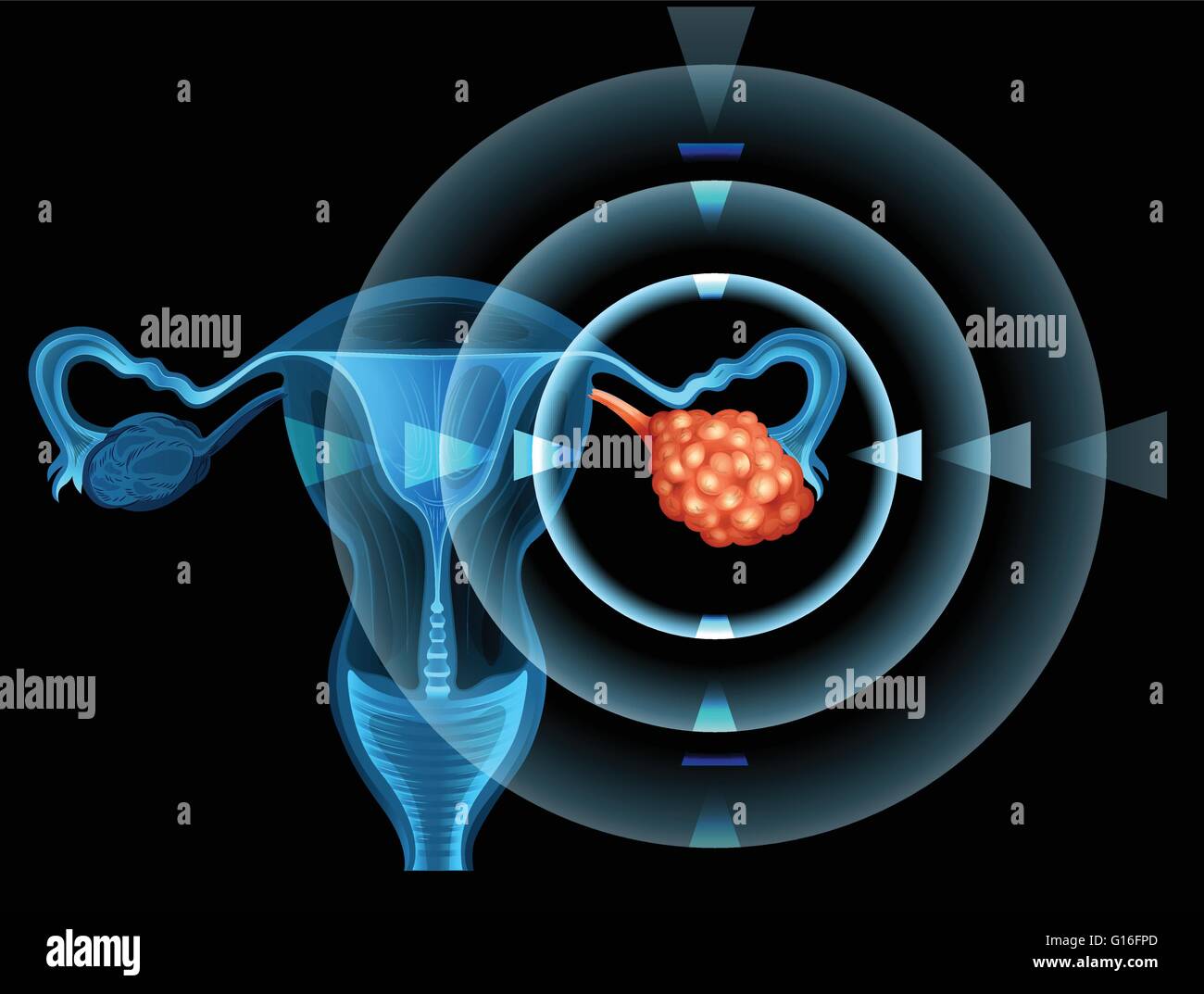 Cancer in ovary of woman illustration Stock Vector Image & Art - Alamy