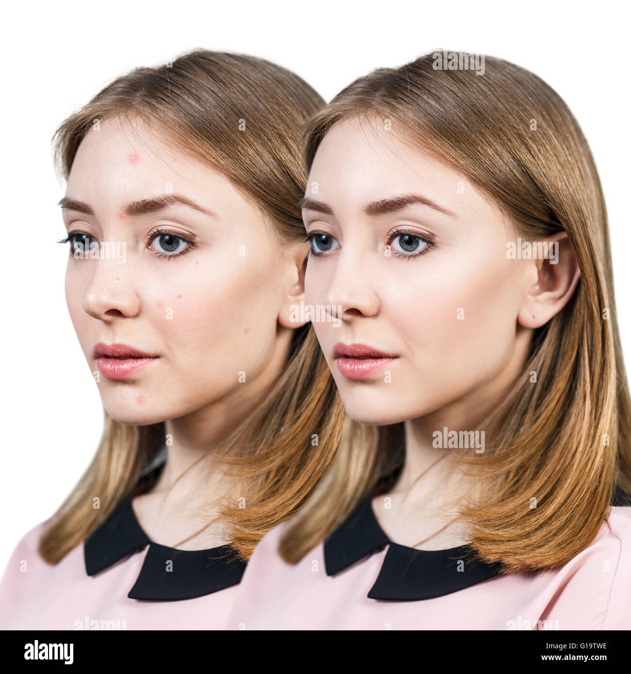 Woman with problem skin on her face before and after treatment isolated ...