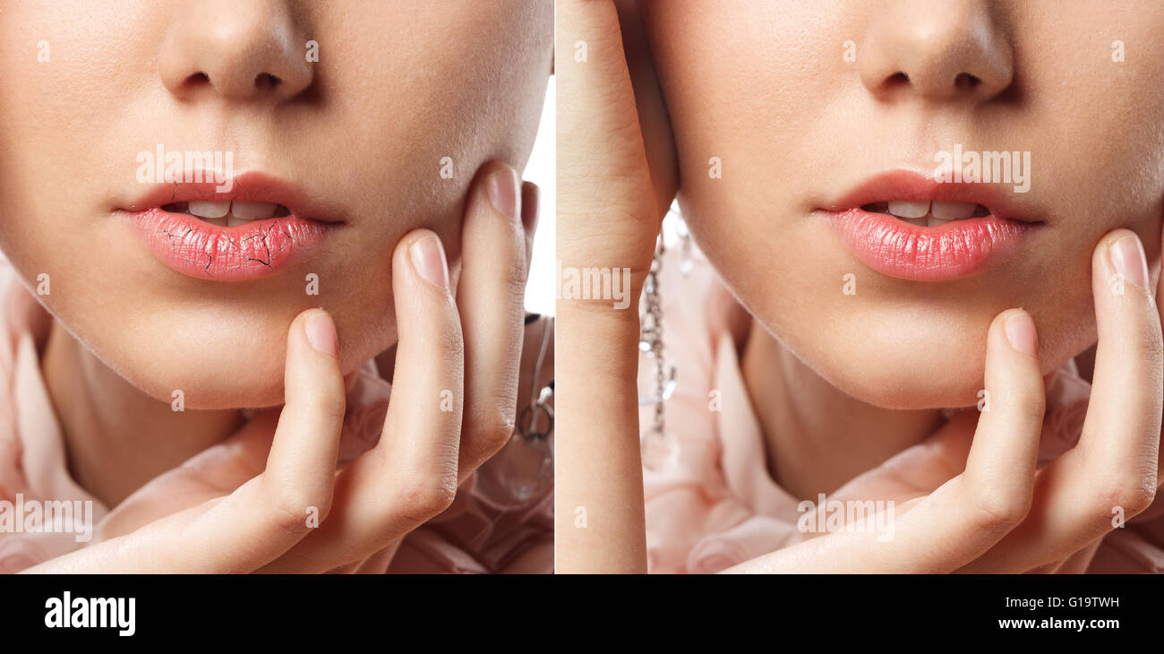 Close up of young female chapped lips before and after treatment Stock ...