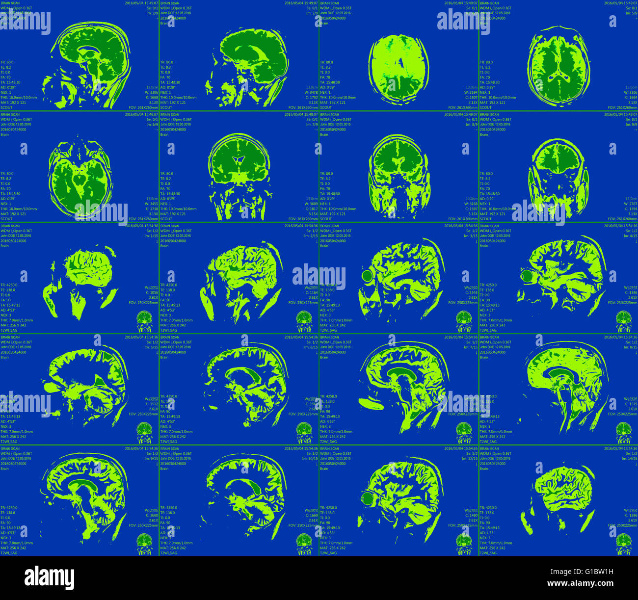 Mri brain scan skull x ray hi-res stock photography and images - Alamy