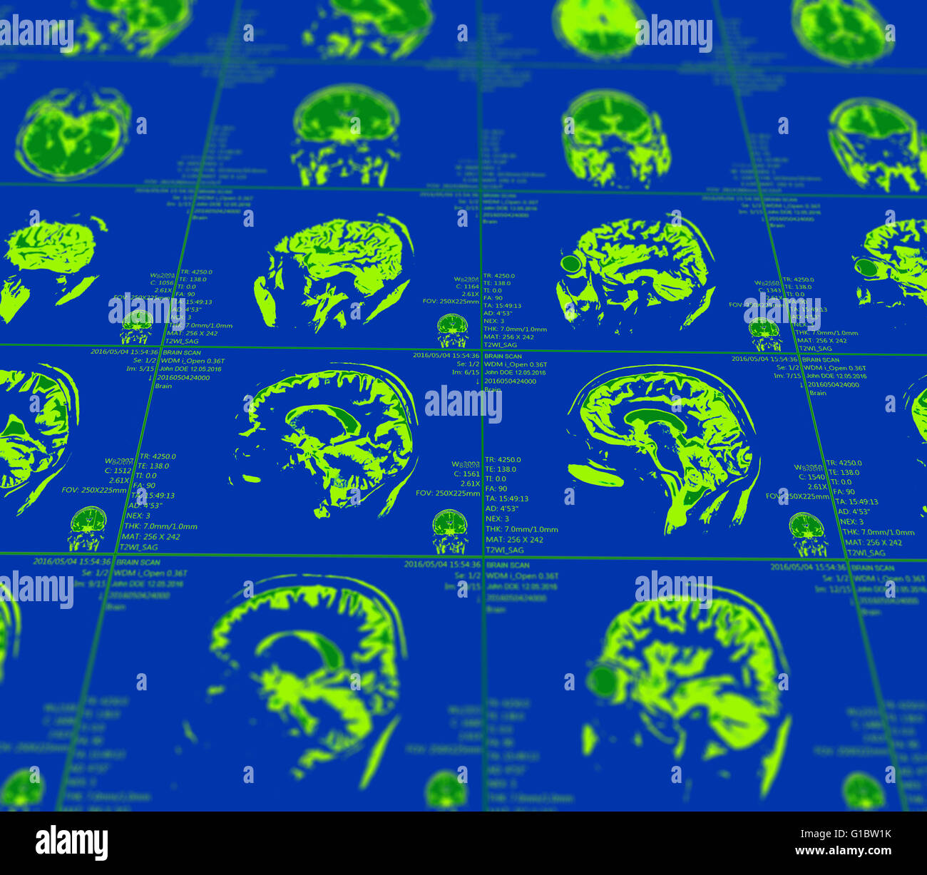 Magnetic resonance imaging of the brain Stock Photo - Alamy