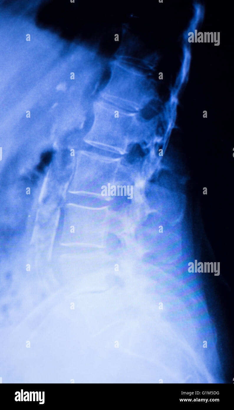 Spinal column, vertebra, neck and back medical x-ray test scan result ...
