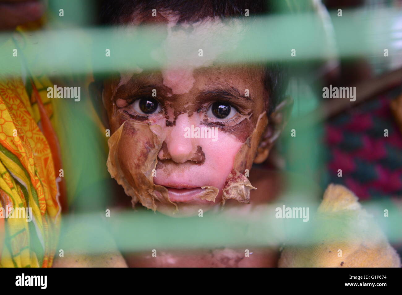 Dhaka, Bangladesh. 18th May, 2016. Tamanna 4 years old, A burn child ...