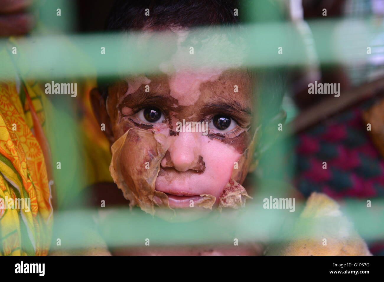 Burn victim child hi-res stock photography and images - Alamy