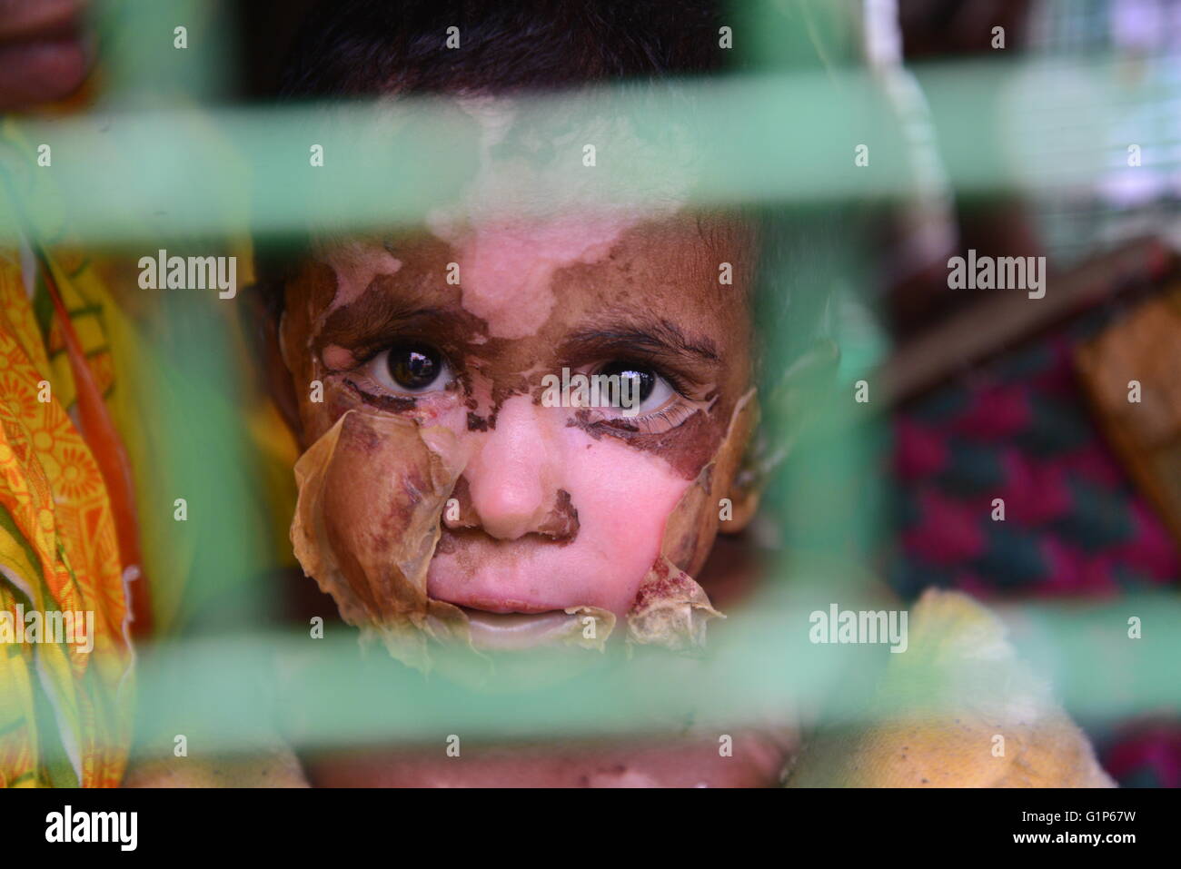 Burn victim child hi-res stock photography and images - Alamy