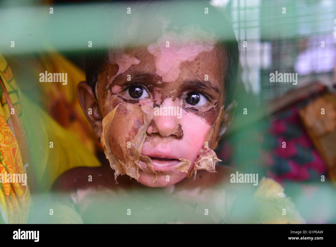 Burn victim child hi-res stock photography and images - Alamy