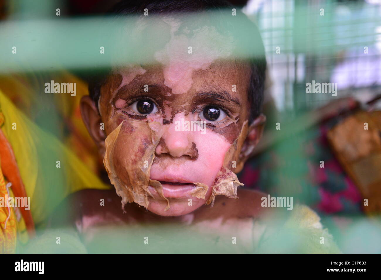 Dhaka, Bangladesh. 18th May, 2016. Tamanna 4 years old, A burn child ...