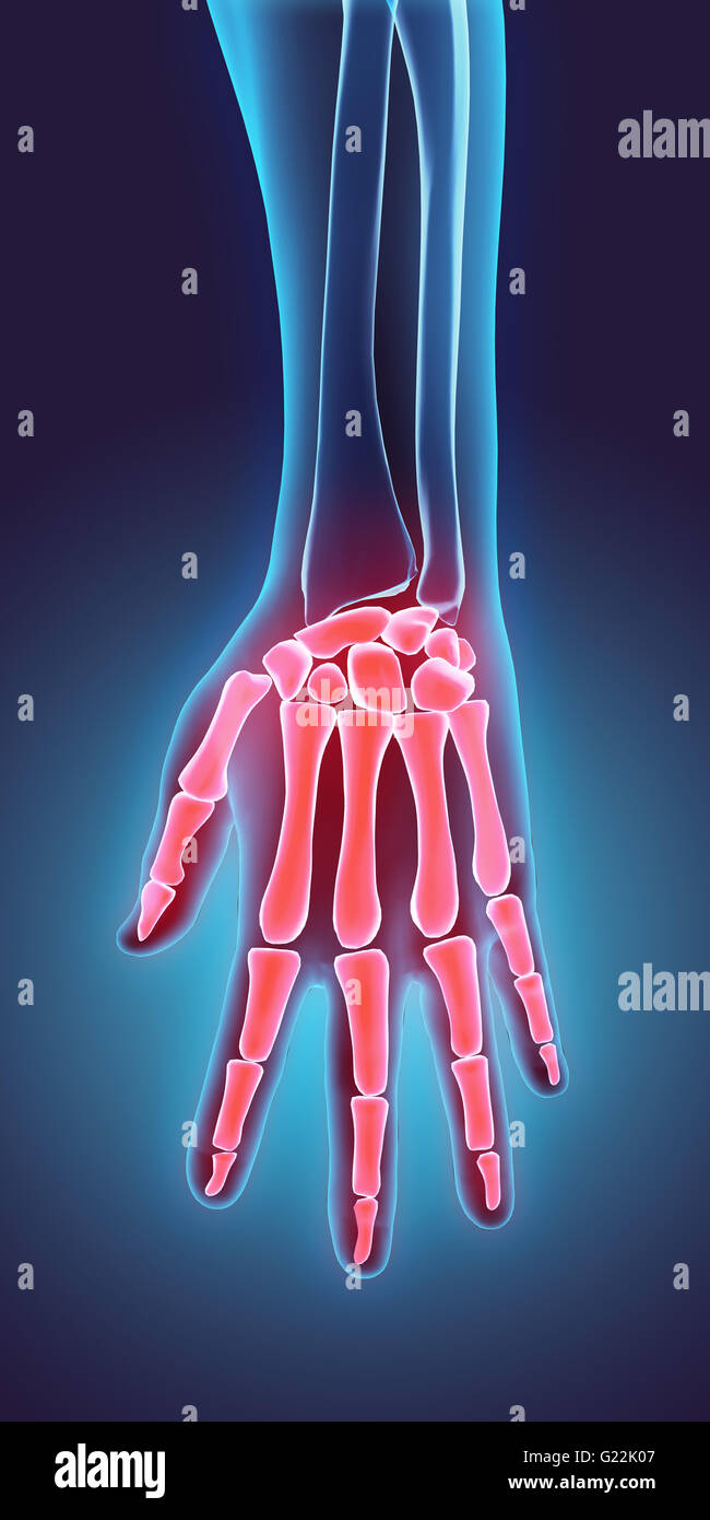 3D illustration of Hand Skeleton - Part of Human Skeleton Stock Photo ...