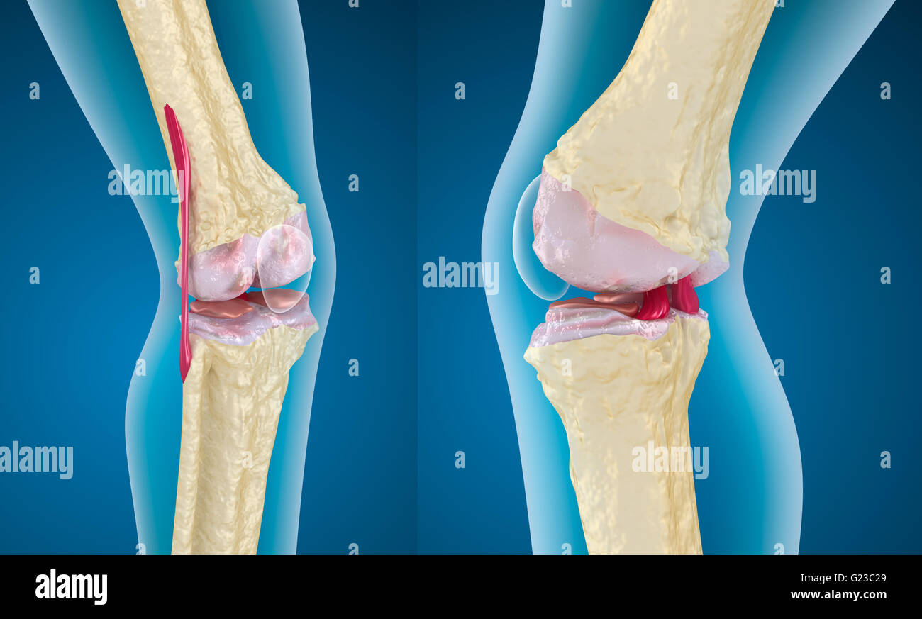 Osteoporosis of the knee joint Stock Photo - Alamy