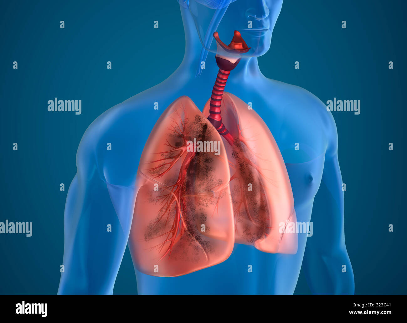 Diseased lungs x-ray view Stock Photo - Alamy