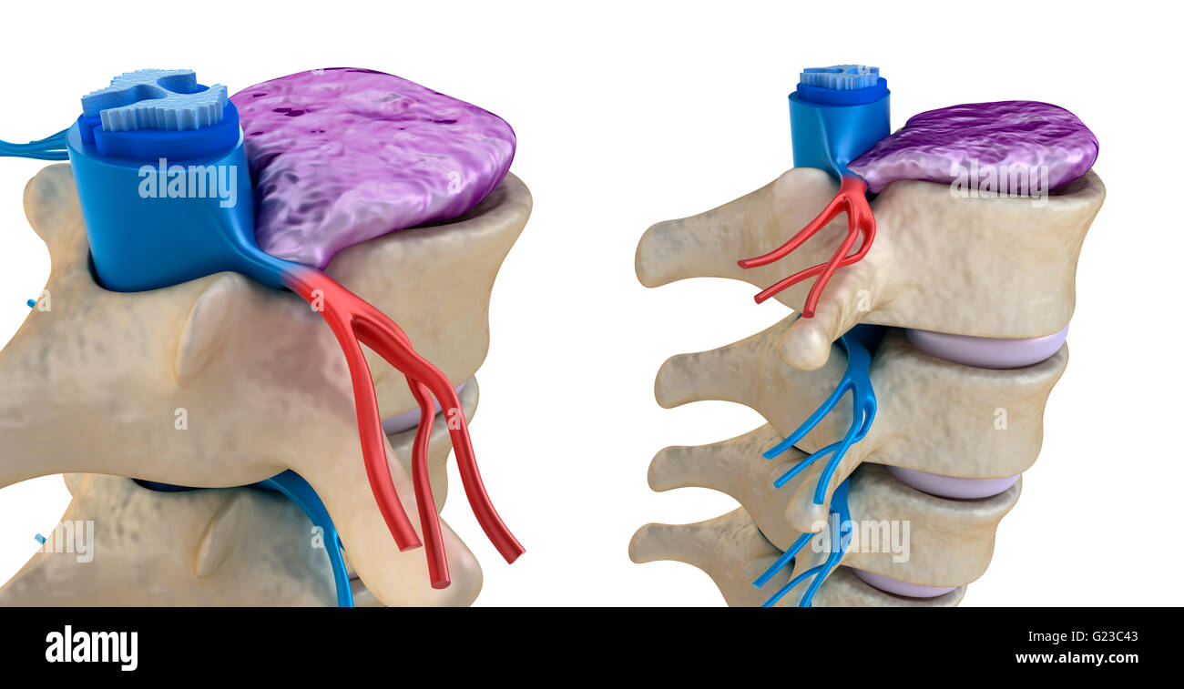 Spinal cord under pressure of bulging disc Stock Photo - Alamy